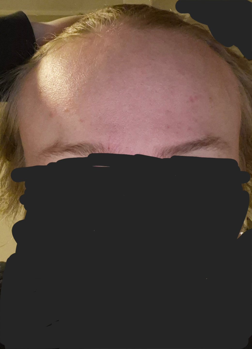 Hair transplant for naturally high hairline - Hair Restoration ...