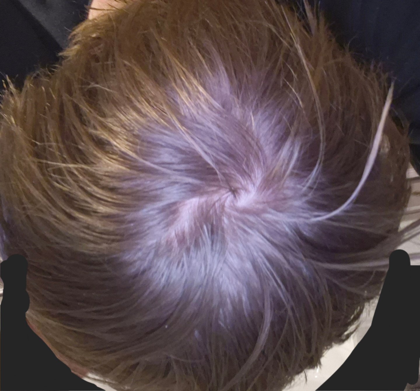 Hair transplant for naturally high hairline - Hair Restoration ...