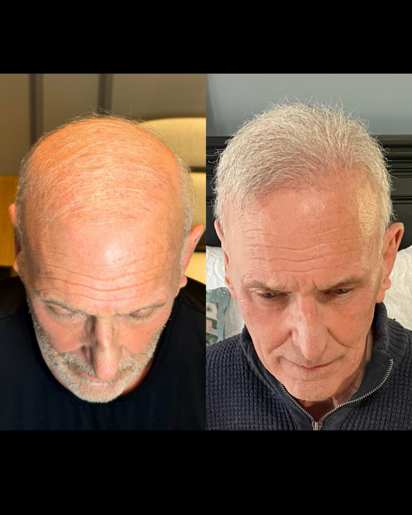 Dr Pitella impossible hair transplant - Hair Restoration Questions and ...