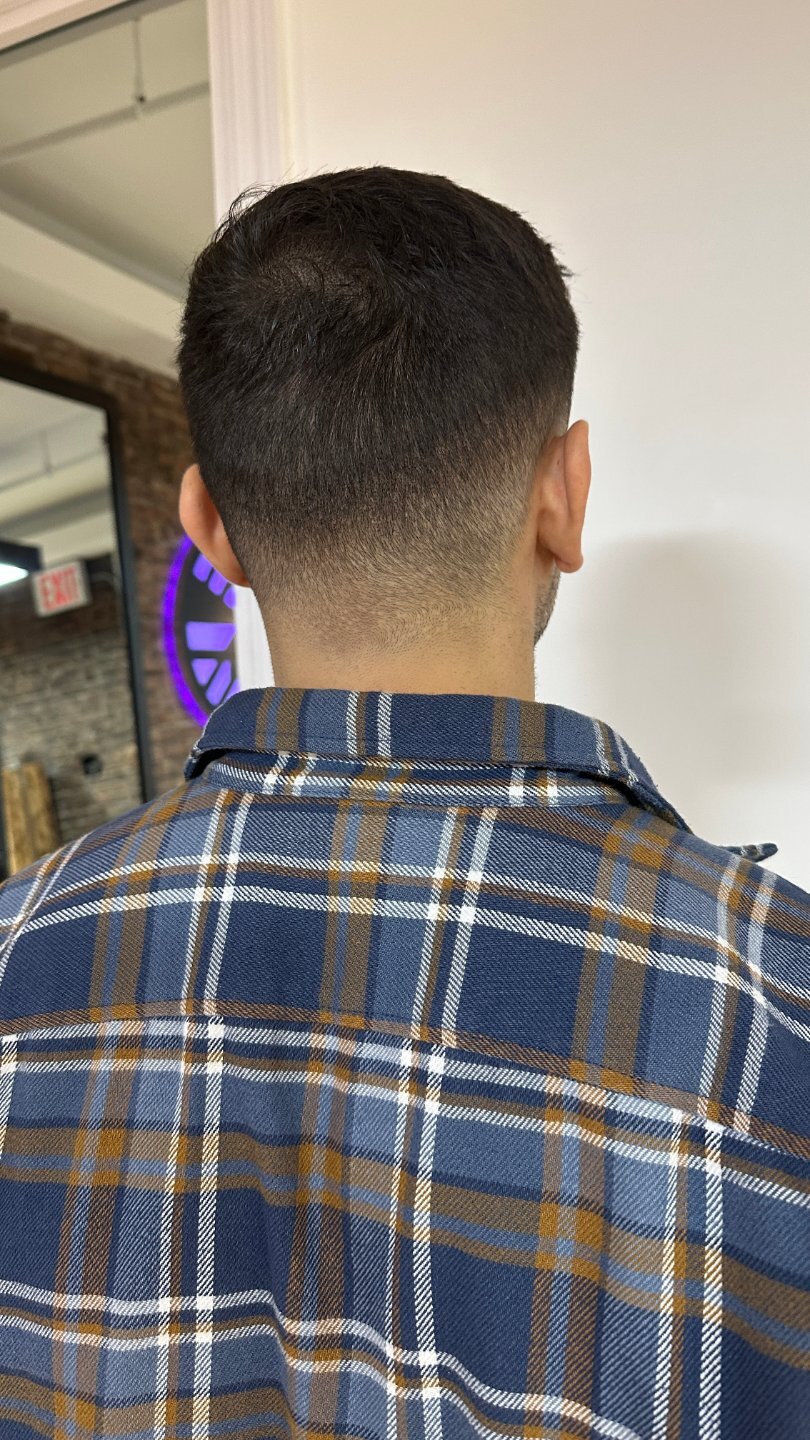 2x Konior FUT scar fill in w/ 400 beard + SMP - Hair Transplant Reviews ...