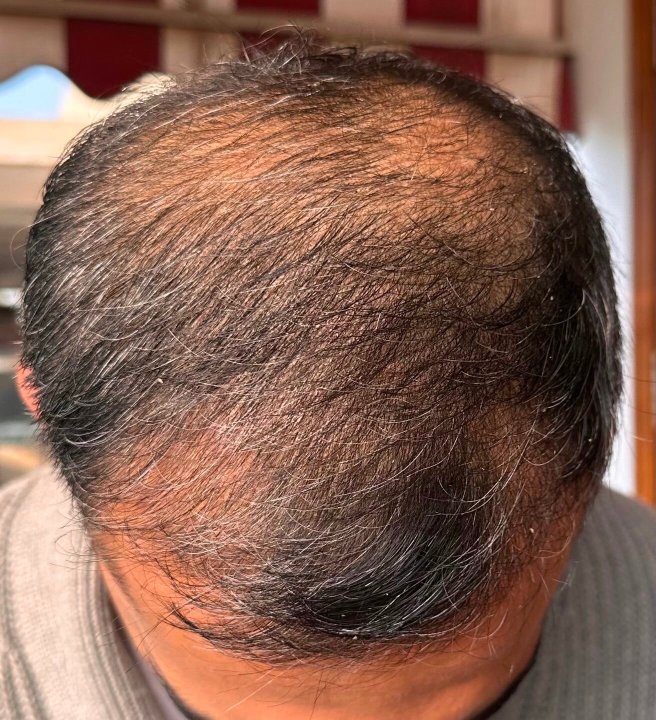 Dr. Alok Sahoo / Alloroots Delhi / 3042 Grafts FUE / 19 October 2024 ...