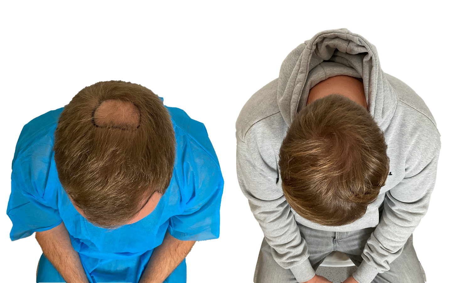 Dr Matt Egan - 3047 Grafts | FUE | Crown and Hairline Touch Up | 12 ...