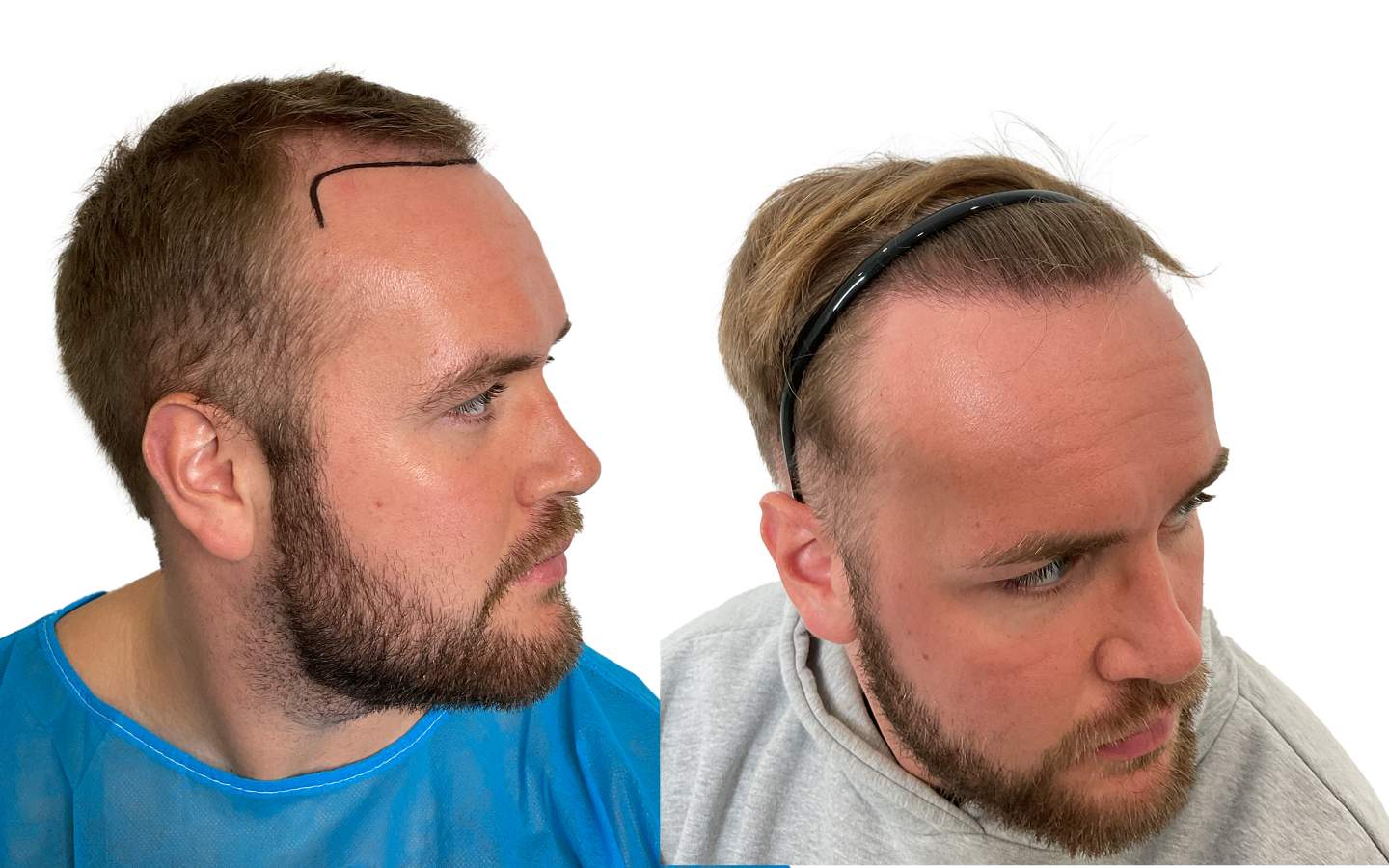 Dr Matt Egan - 3047 Grafts | FUE | Crown and Hairline Touch Up | 12 ...