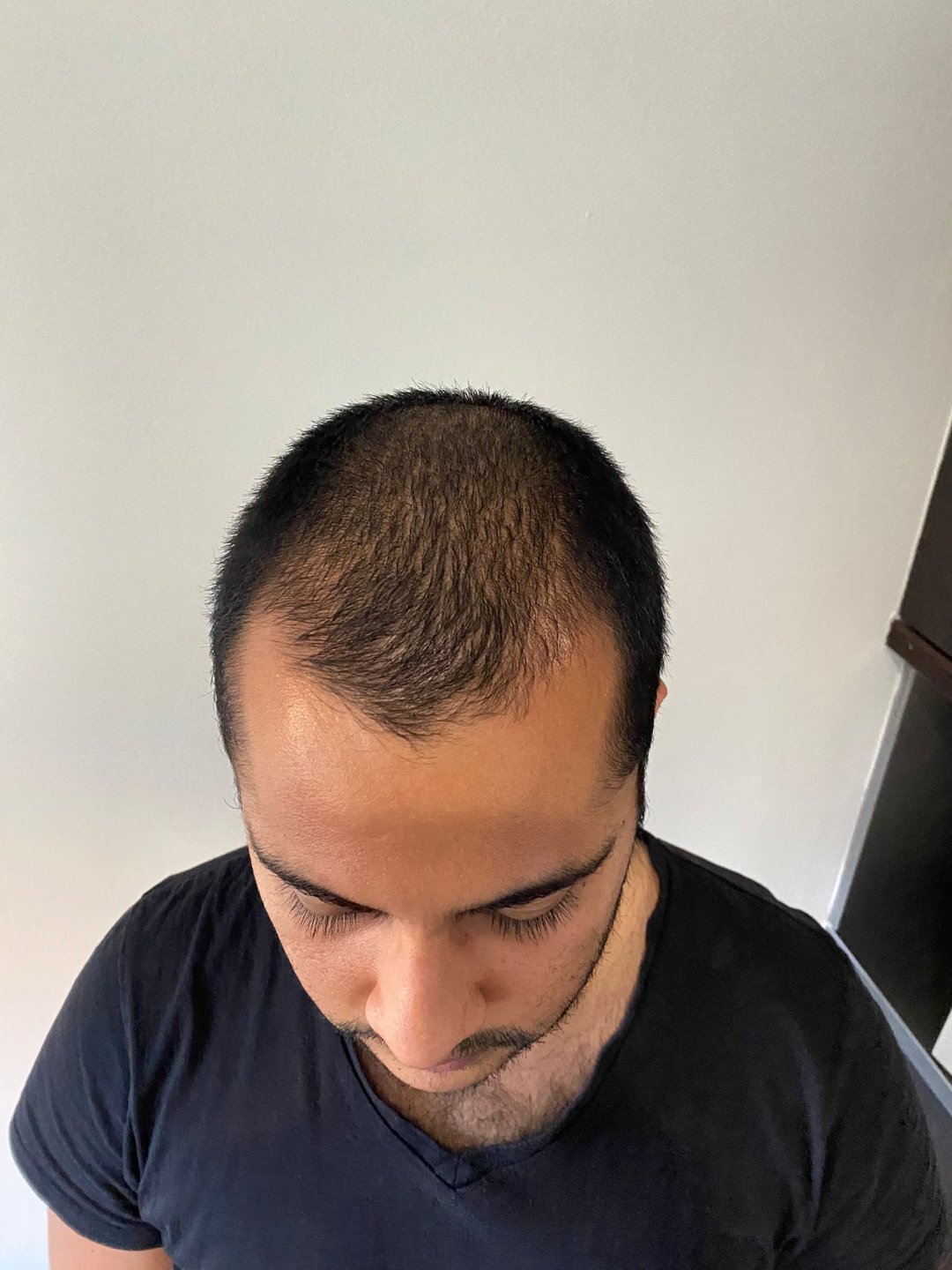 Booked a Hair Transplant with Now Hair Time - Looking for Experiences ...