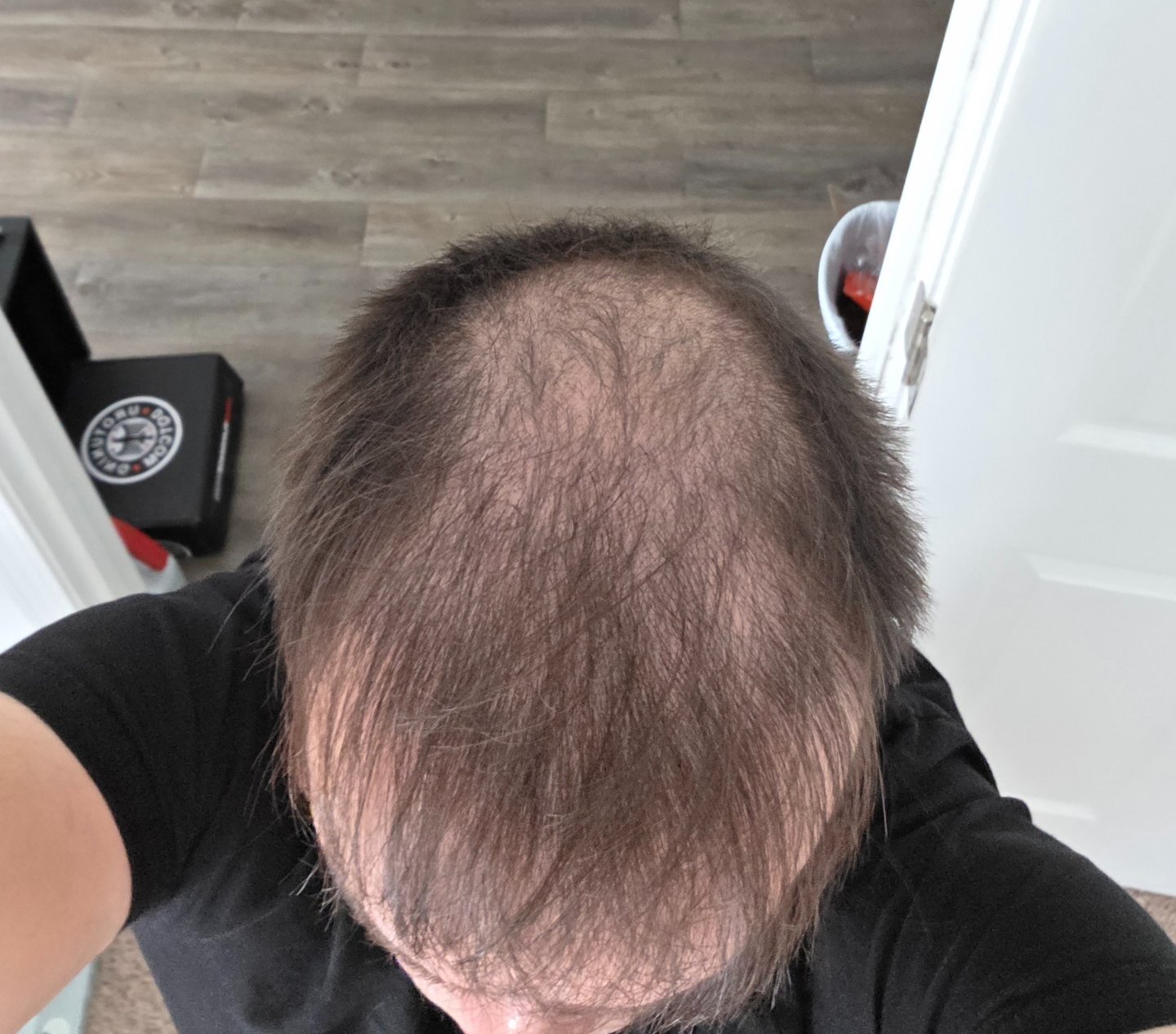 Is this saveable or should I give it up? - Hair Restoration Questions ...