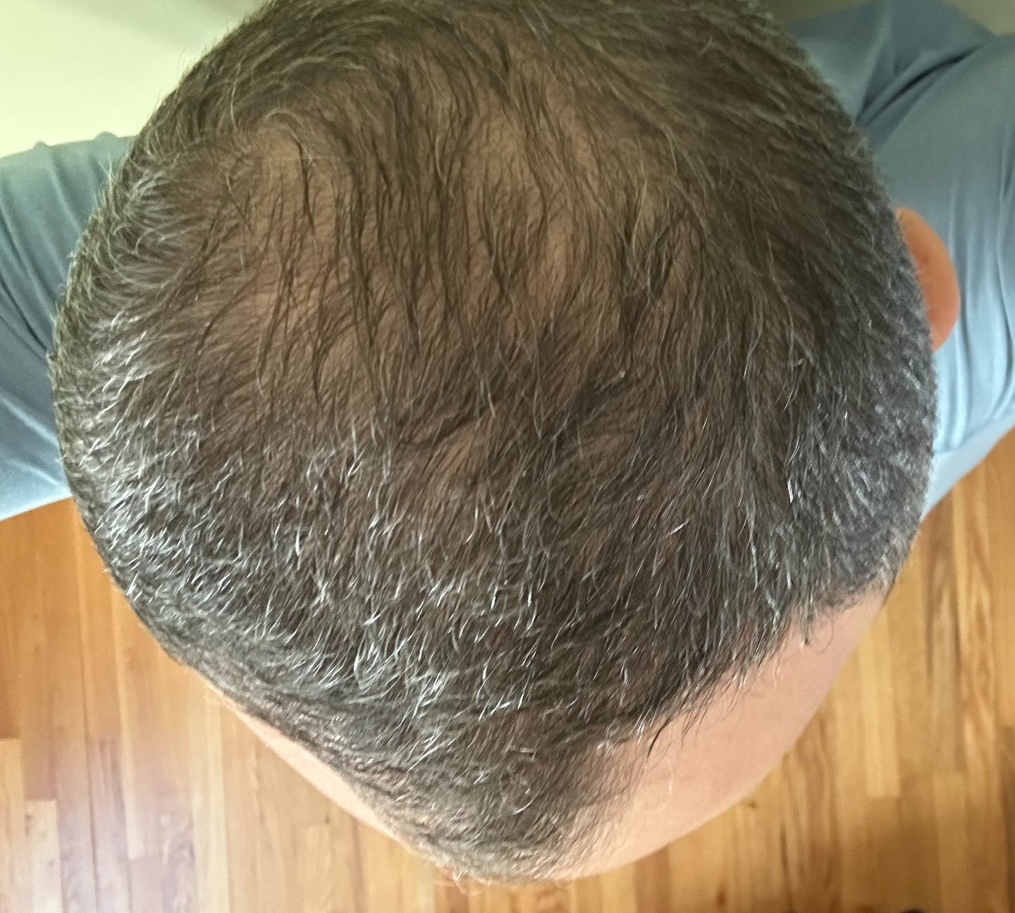 Pls help me FINALLY make a decision after 20 yrs. Go for HT or shave it ...