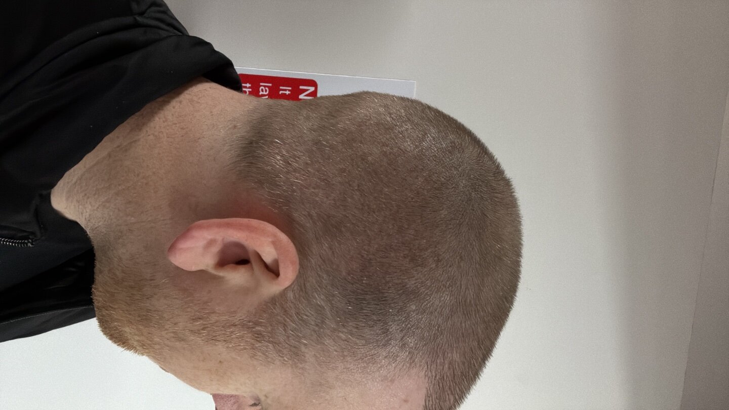 dr Vikas Kunnure UK Hair - Hair Transplant Reviews - Hair Restoration ...