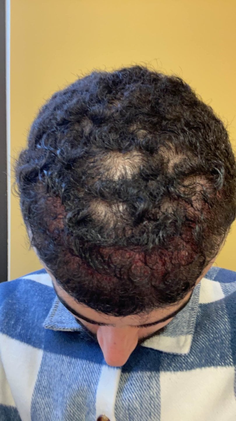 Robert Haber at Haber Dermatology FAILED 1416 Graft FUT hair transplant ...