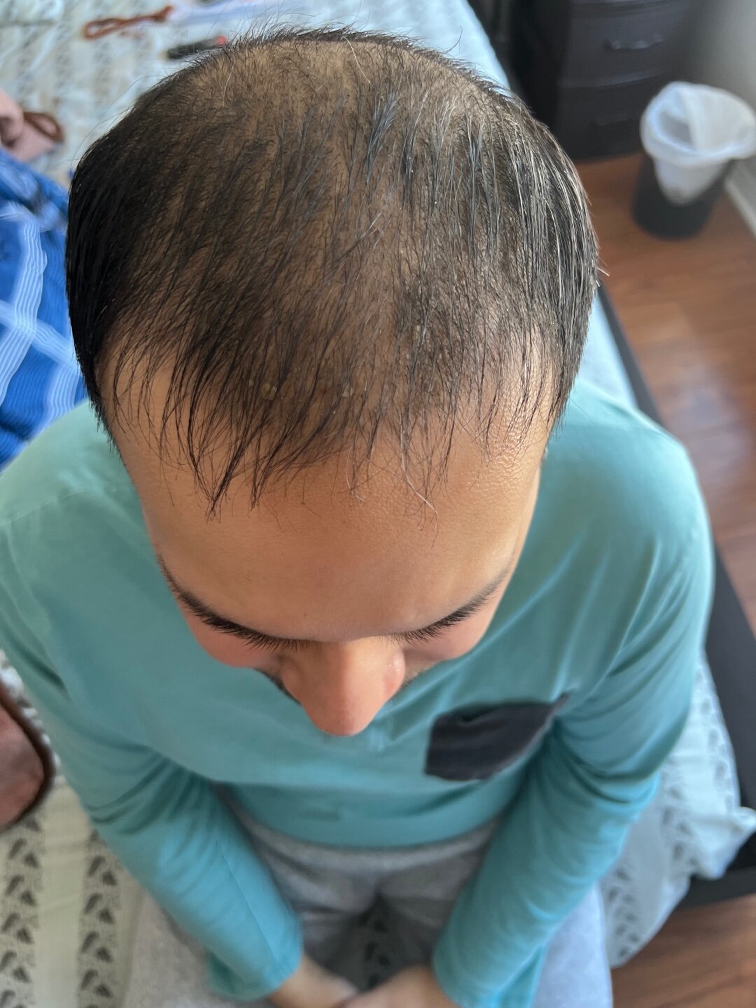 Dr Resul Yaman - Istanbul- Oct 19th 2024 - 4780 grafts - Page 2 - Hair ...