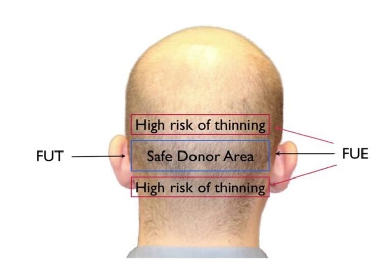 Fin - Hair Loss Drugs - Hair Restoration Network - Forum For and By ...
