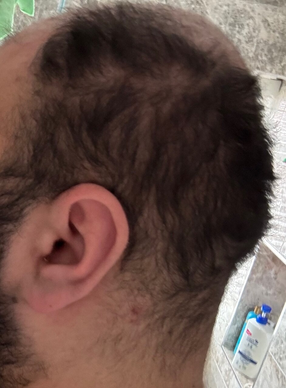 Suitability of hairtransplant? Best step forward? - Hair Restoration ...