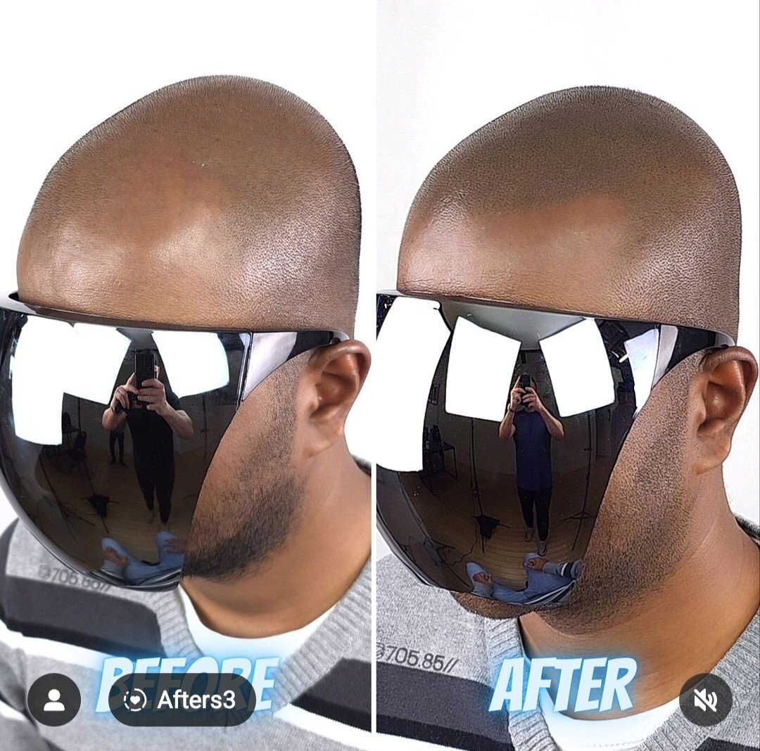 My Wonderful SMP Journey - Scalp Micropigmentation (SMP) - Hair ...