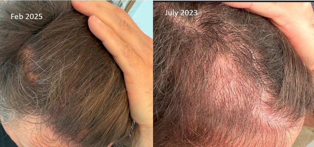 Xyon 2% Dutasteride Siloxysytem Gel Journey - Page 19 - Hair Loss Drugs ...