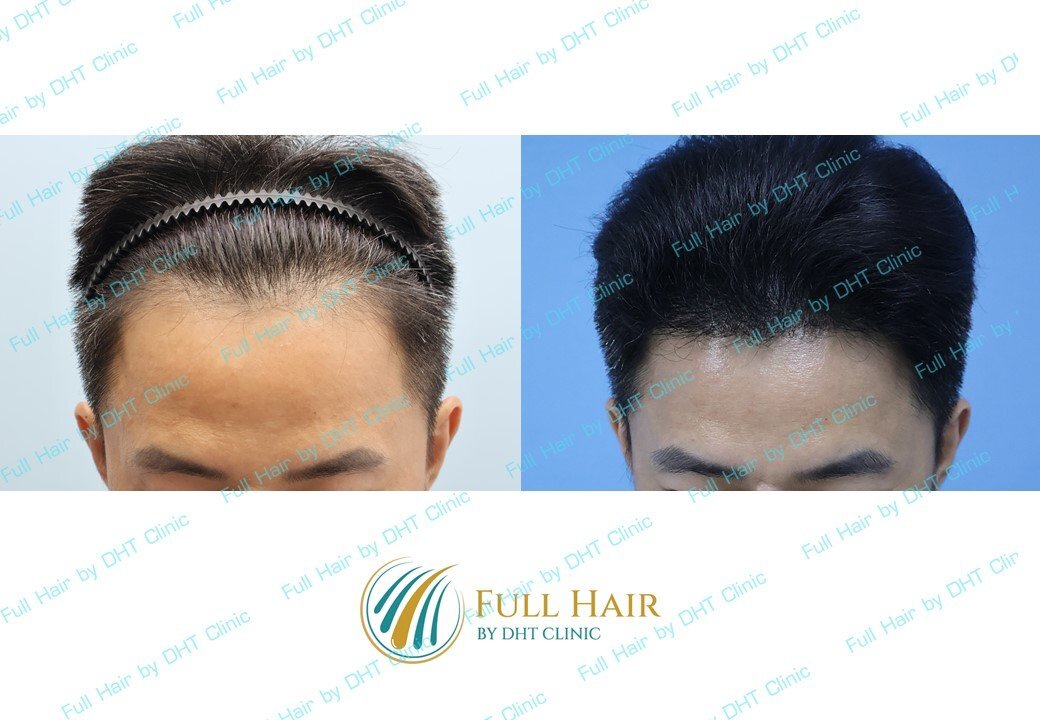 Dr. Pasu Piamphongsant - Full Hair by DHT Clinic, Bangkok - 1,636 ...