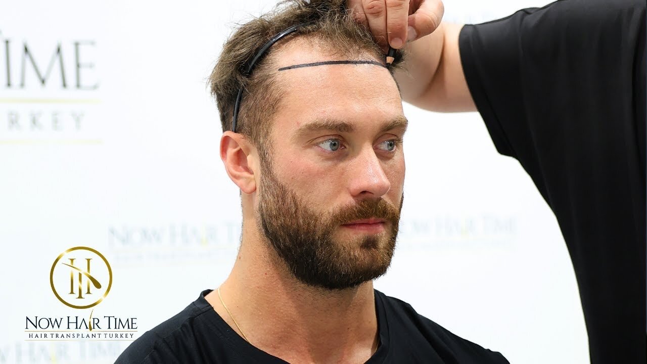 Does Cbum HT look natural? - Hair Restoration Questions and Answers ...