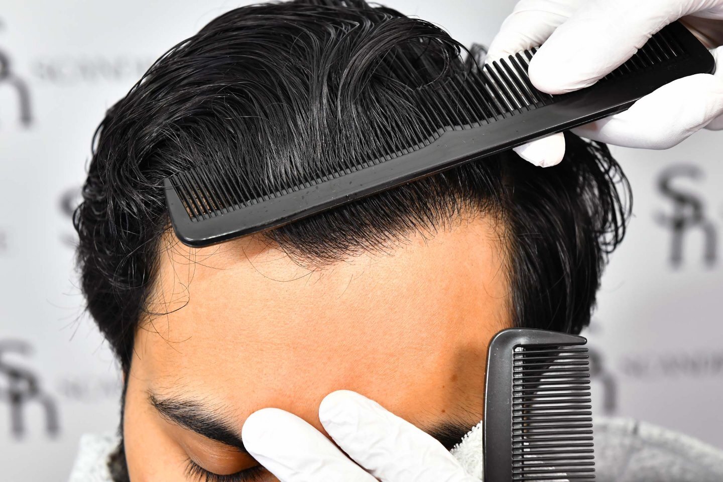 Dr Emil George, Oslo, Norway - 1200 FUE grafts. 33 y old patient ...