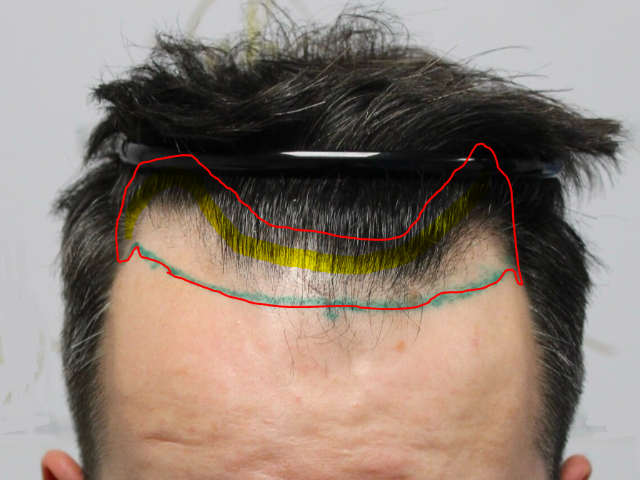 Hairloss stabilised? - Hair Restoration Questions and Answers - Hair ...