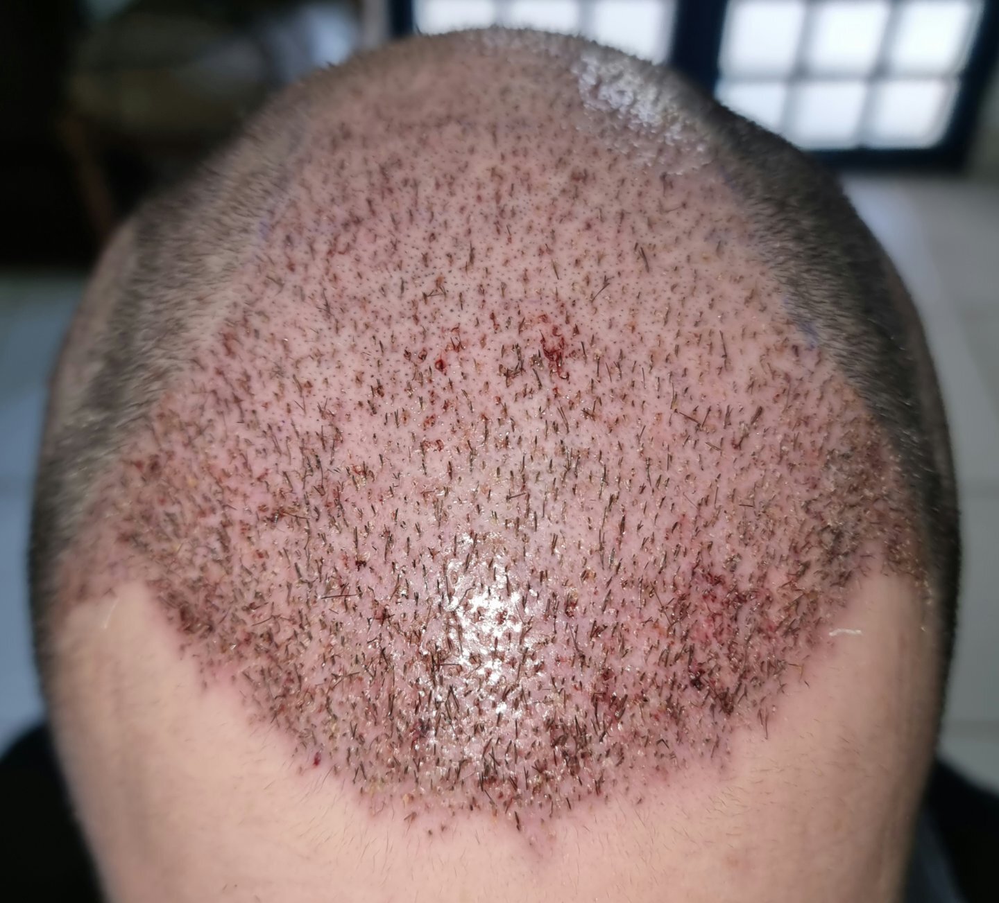 Continuous hair loss after hair transplant - Hair Restoration Questions ...