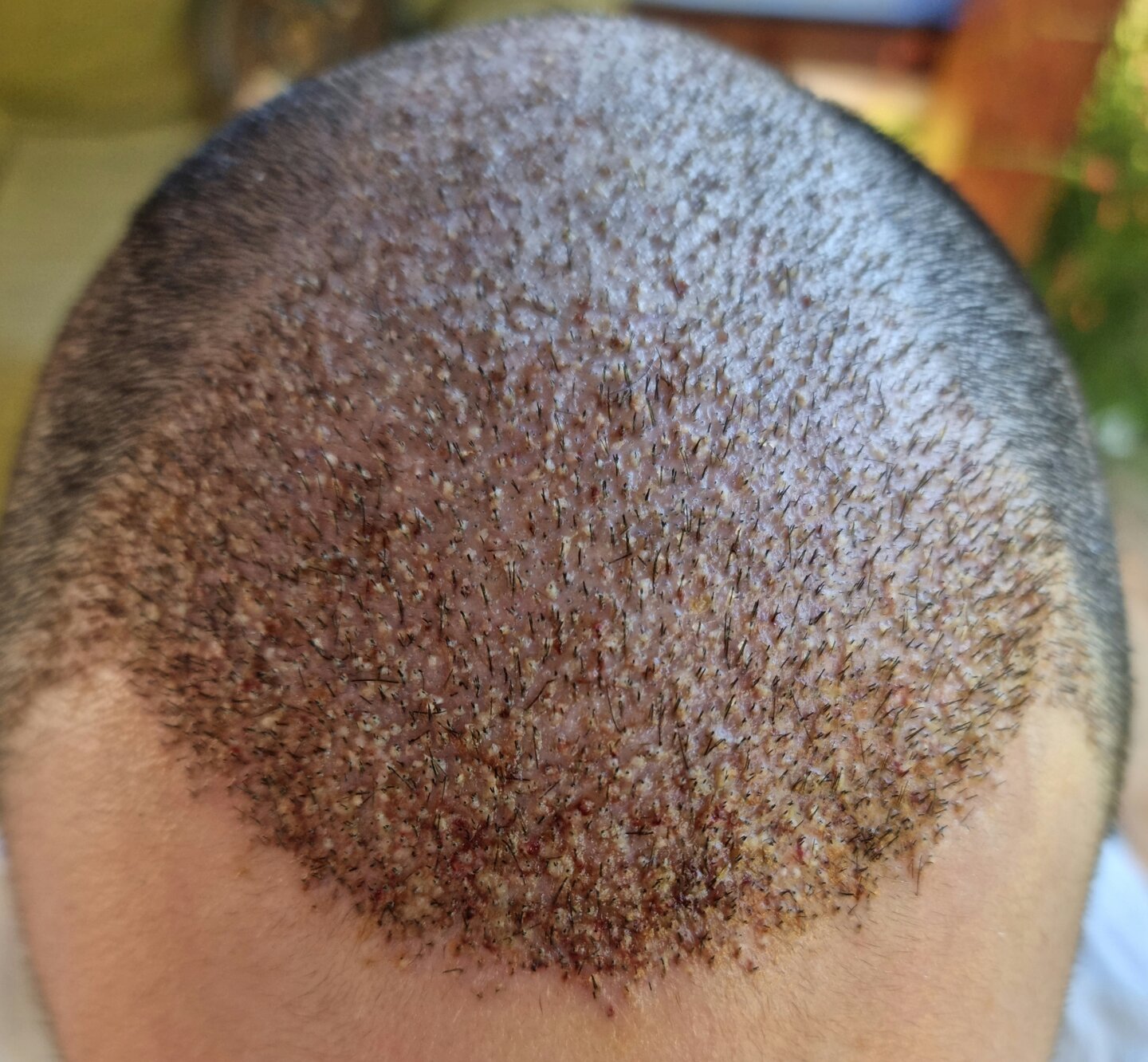 Continuous hair loss after hair transplant - Hair Restoration Questions ...