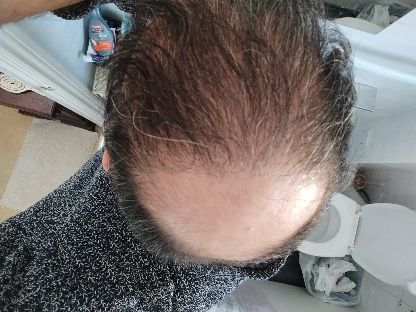 Hairline after hair transplant looks very uneven/wonky - Hair ...