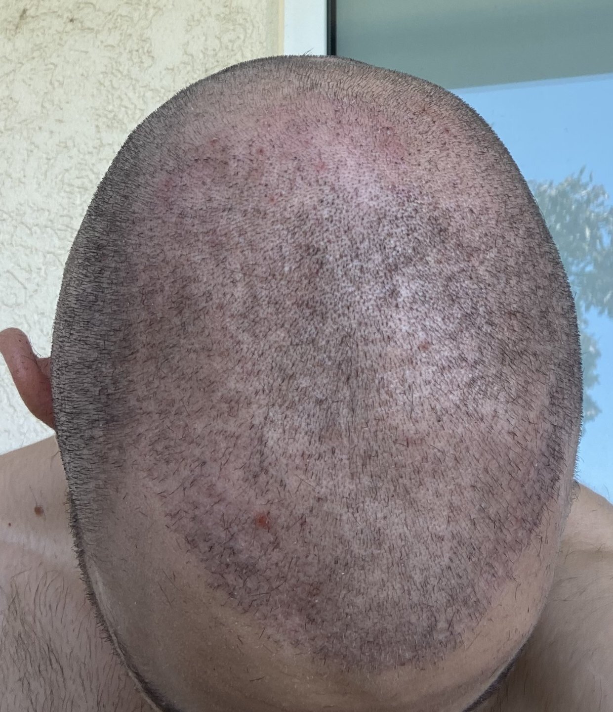 Does anyone have pictures of a hair transplant that didn't go well ...