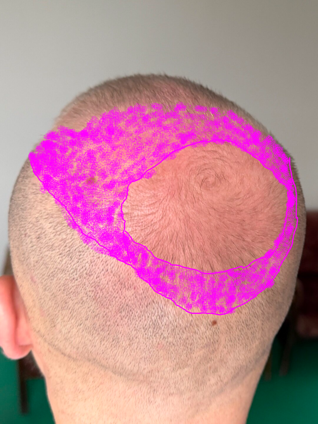 Planning a hair transplant, considering Eugenix. Need your advice ...