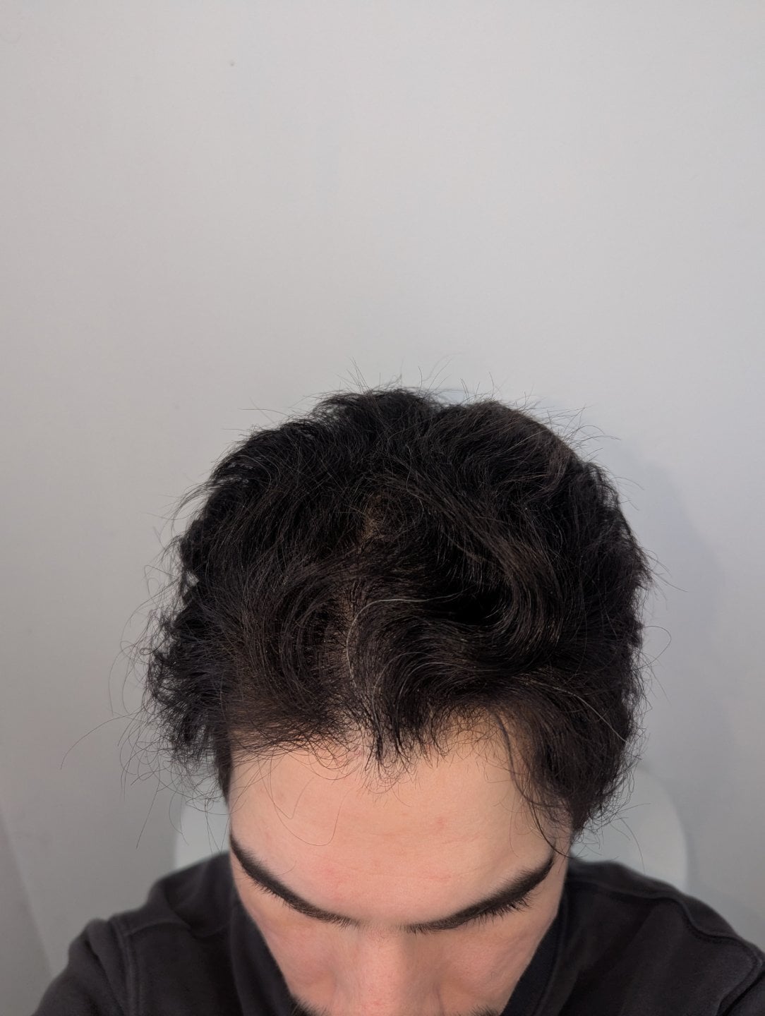 Pittella - 6875 Grafts (scalp only) - June 27th, 2024 - Page 2 - Hair ...