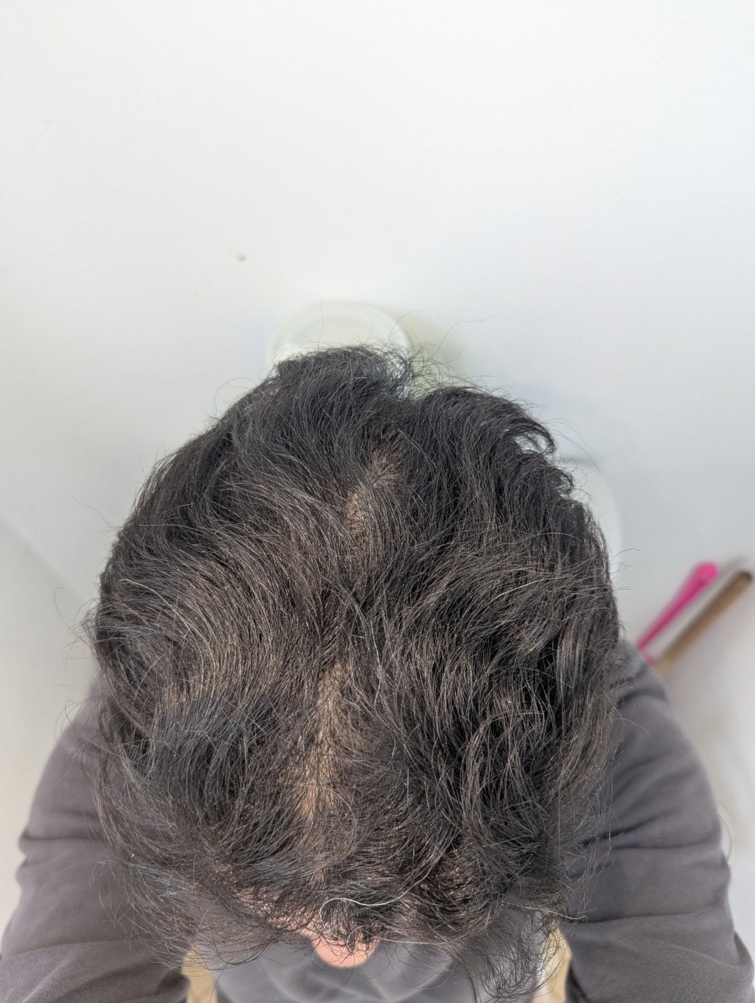 Pittella - 6875 Grafts (scalp only) - June 27th, 2024 - Page 2 - Hair ...