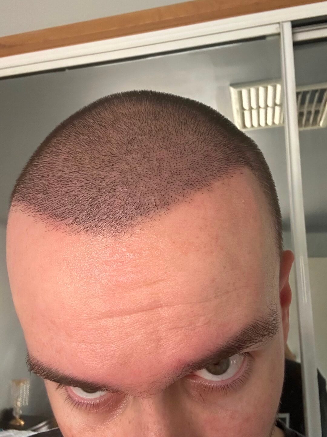 Dr Ruk, 3763 grafts (9428 hairs), 28 years old norwood 3-4 - Hair ...