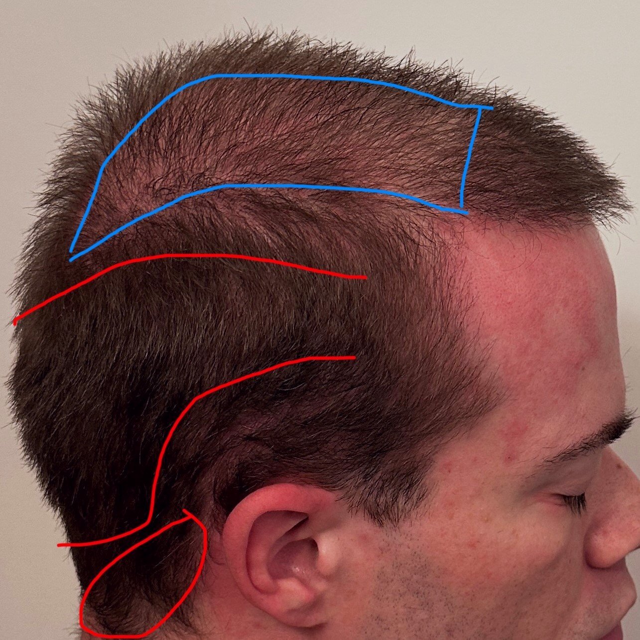 Eugenix (Drs. Das/Somesh/Vinita) | 11,102 grafts | NW 6/7 | 28 yrs old ...