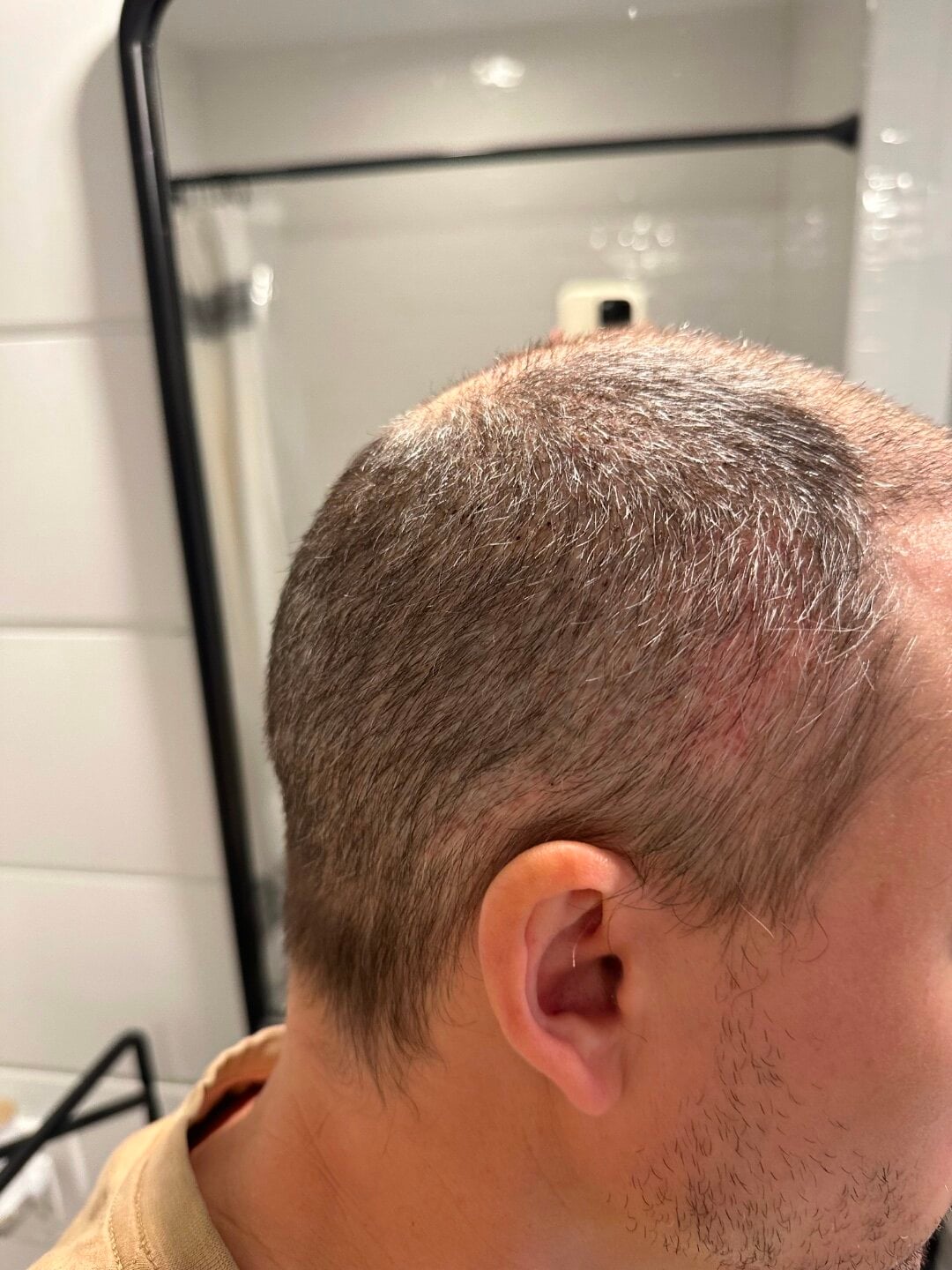 5,000 FUE with Dr Bloxham - Hair Transplant Reviews - Hair Restoration ...