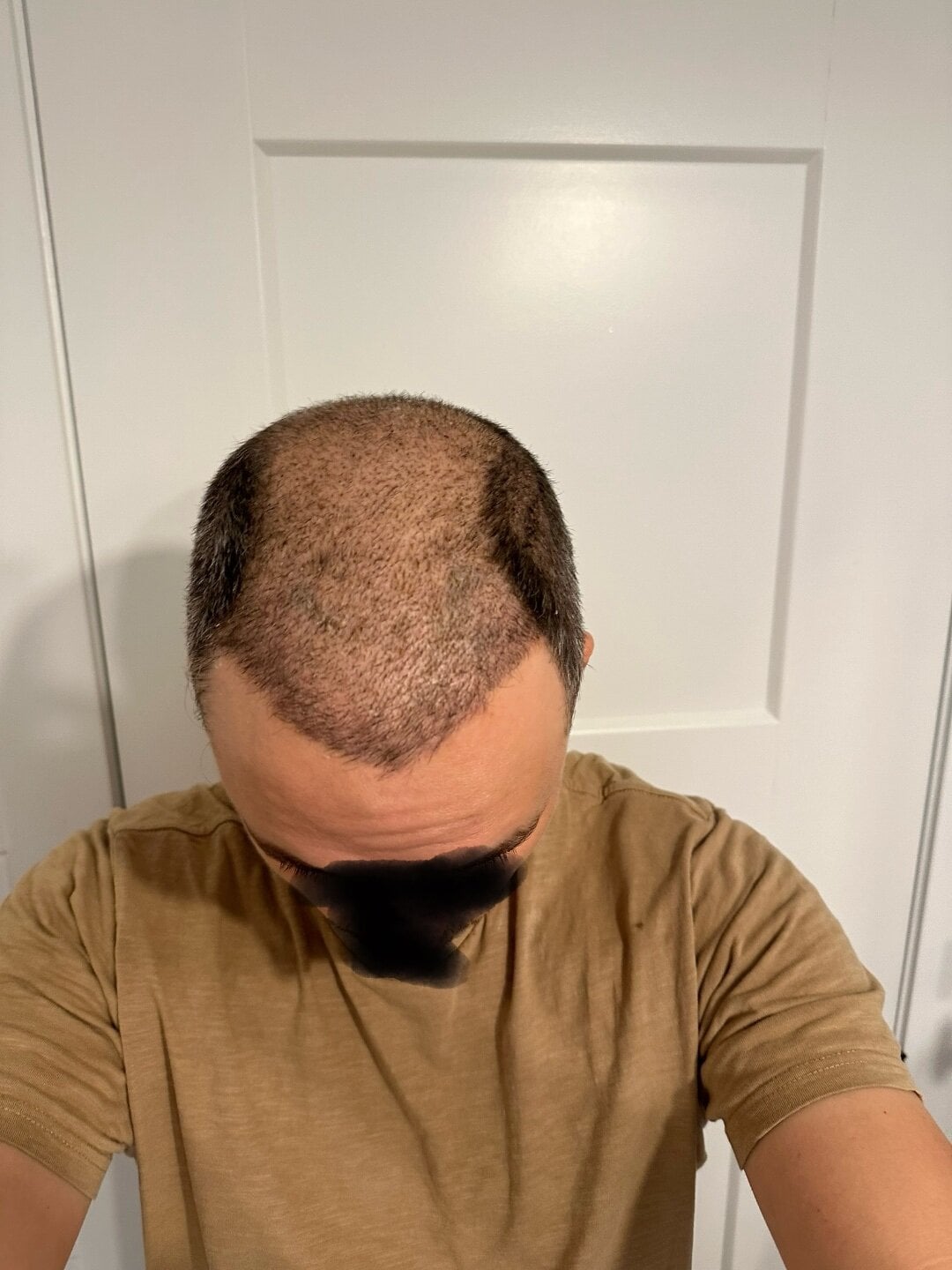 5,000 FUE with Dr Bloxham - Hair Transplant Reviews - Hair Restoration ...