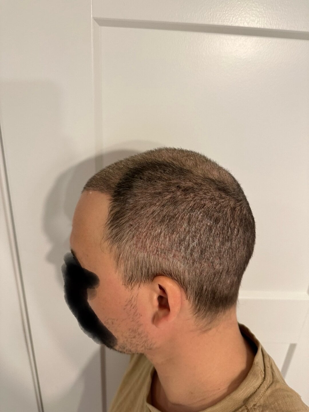 5,000 FUE with Dr Bloxham - Hair Transplant Reviews - Hair Restoration ...