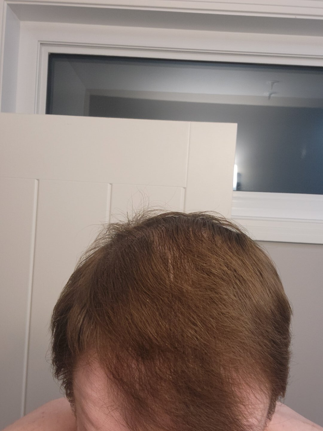 Wondering what my options are. - Hair Restoration Questions and Answers ...