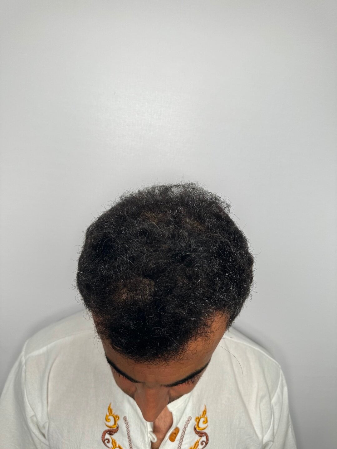 Dr Emil George, 4 k + grafts, done 1.5 years ago. Round 2 planned for ...