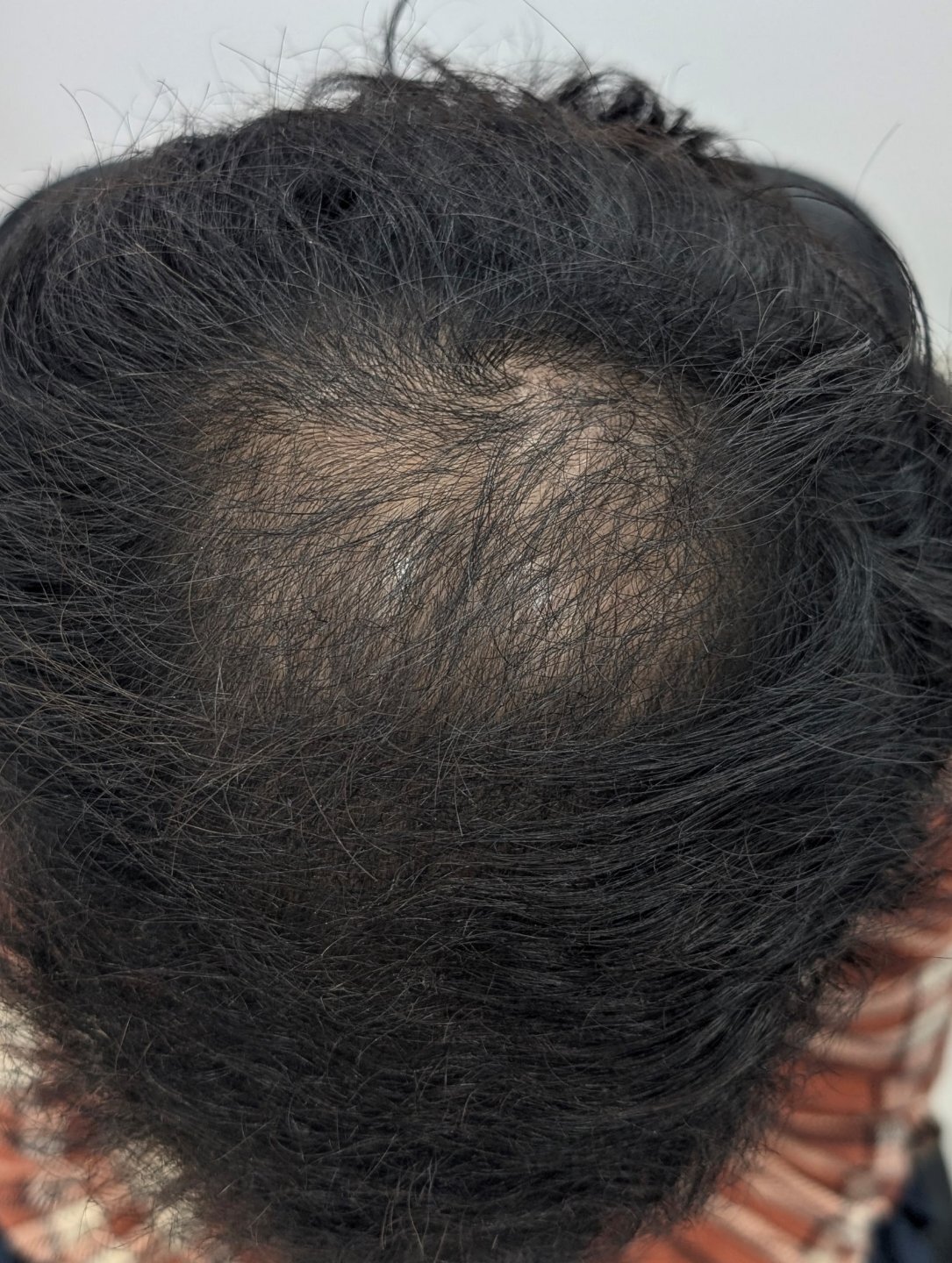 4560 Grafts in Frontal Area Grade VI I Dr. Tushar I Nuleaf Clinic Pune ...