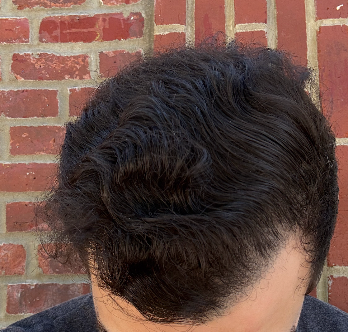 Dr. Ted Miln | 9425 total grafts | 2 FUT/FUE Combo Procedures - Page 6 ...