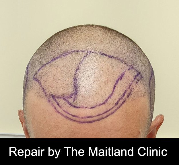 Unnatural Turkish Hairline FIXED! Sapphire Hair Clinic, Istanbul ruined ...