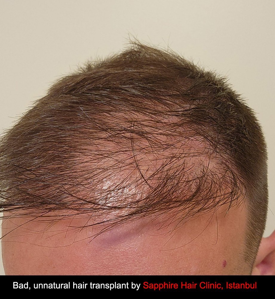 Unnatural Turkish Hairline FIXED! Sapphire Hair Clinic, Istanbul ruined ...