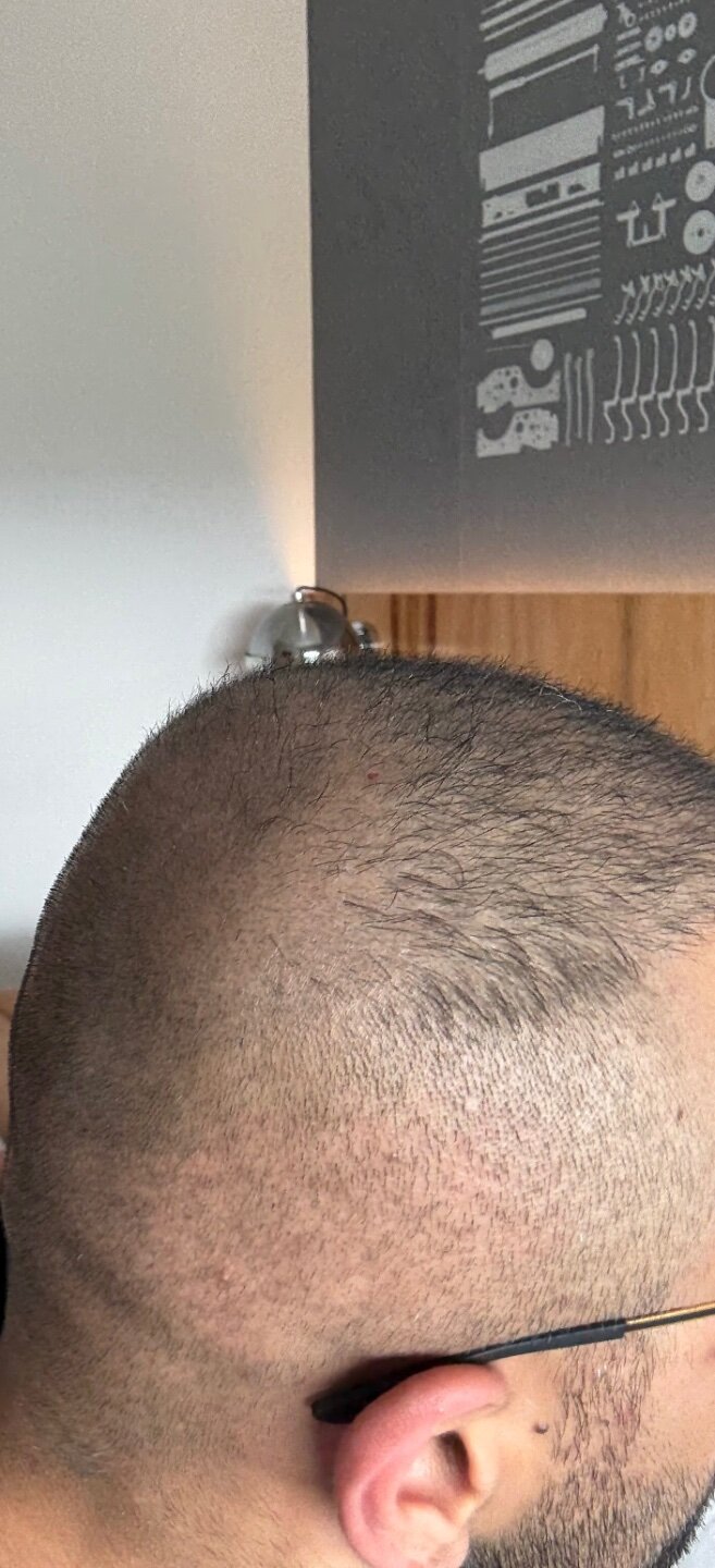 Eugenix | Dr Das | NW7 | 3500 grafts | March 2024 - Hair Transplant ...