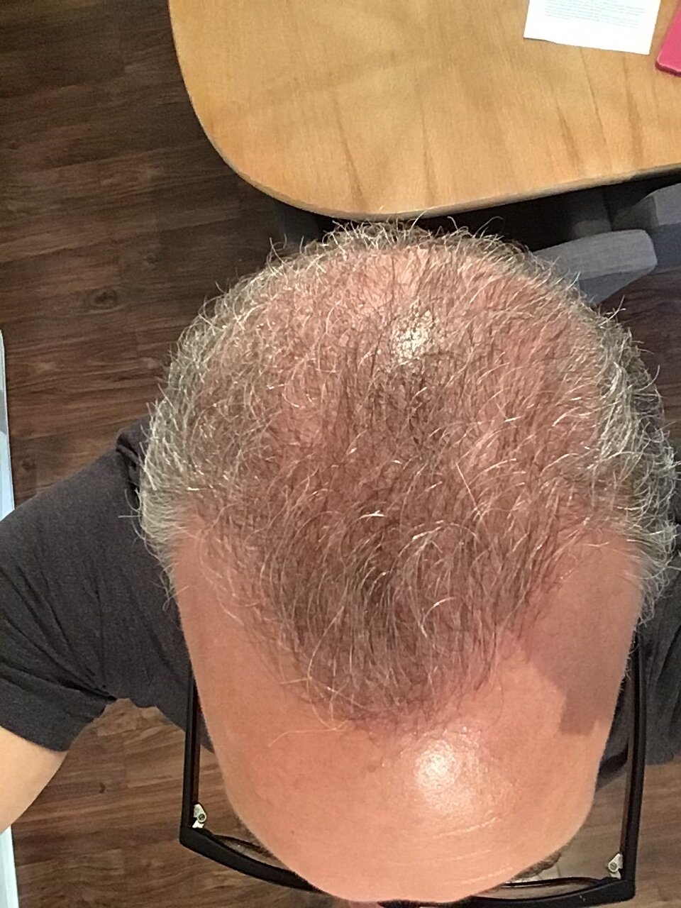 Unsure about hair transplant - would appreciate your input - Hair ...