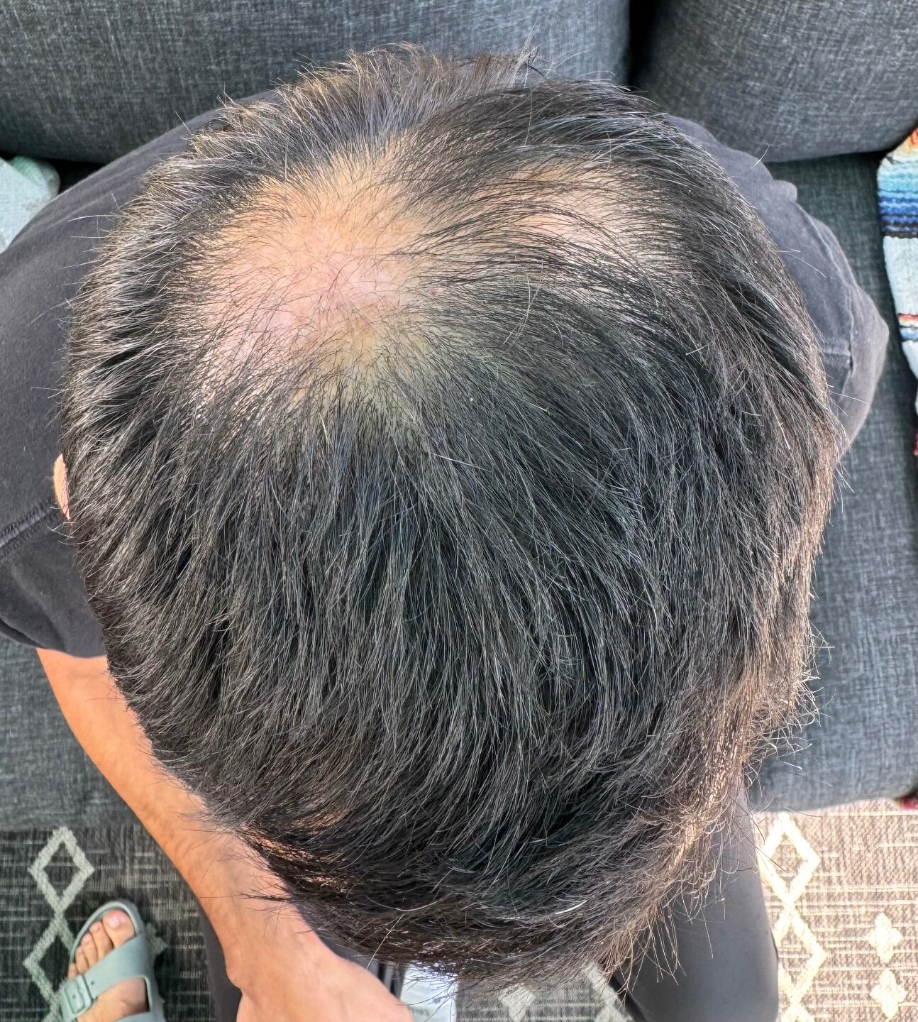 Looking for recent reviews on Dr Ross- San Diego - Hair Transplant ...