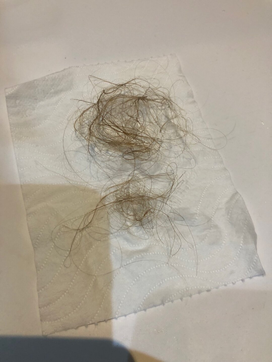 Long time hair loss sufferer, needs advice on next step/hair transplant ...