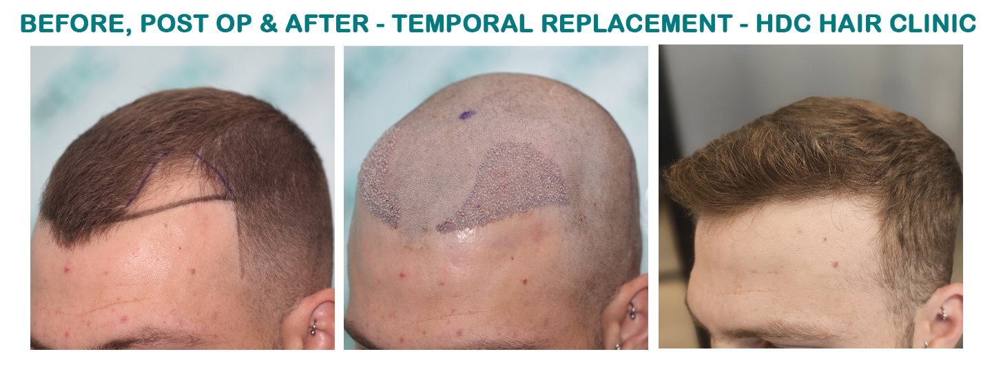 Temporal Hair Restoration with 2000 FUE Grafts – HDC Hair Clinic – Dr ...