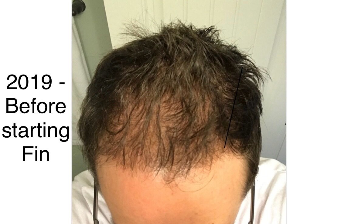 Who is the absolute best for diffuse thinning HT? Outside of Laorwong ...