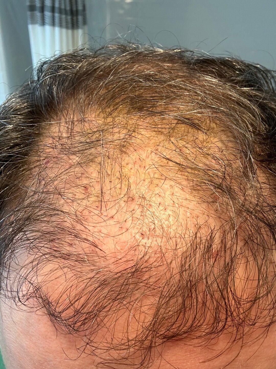 5,000 FUE with Dr Bloxham - Hair Transplant Reviews - Hair Restoration ...