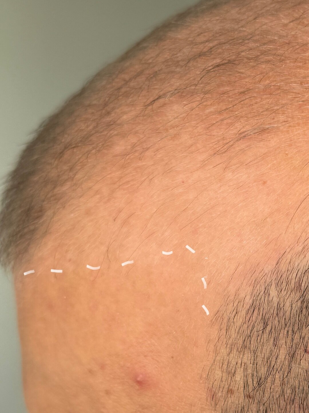 Planning a hair transplant, considering Eugenix. Need your advice ...