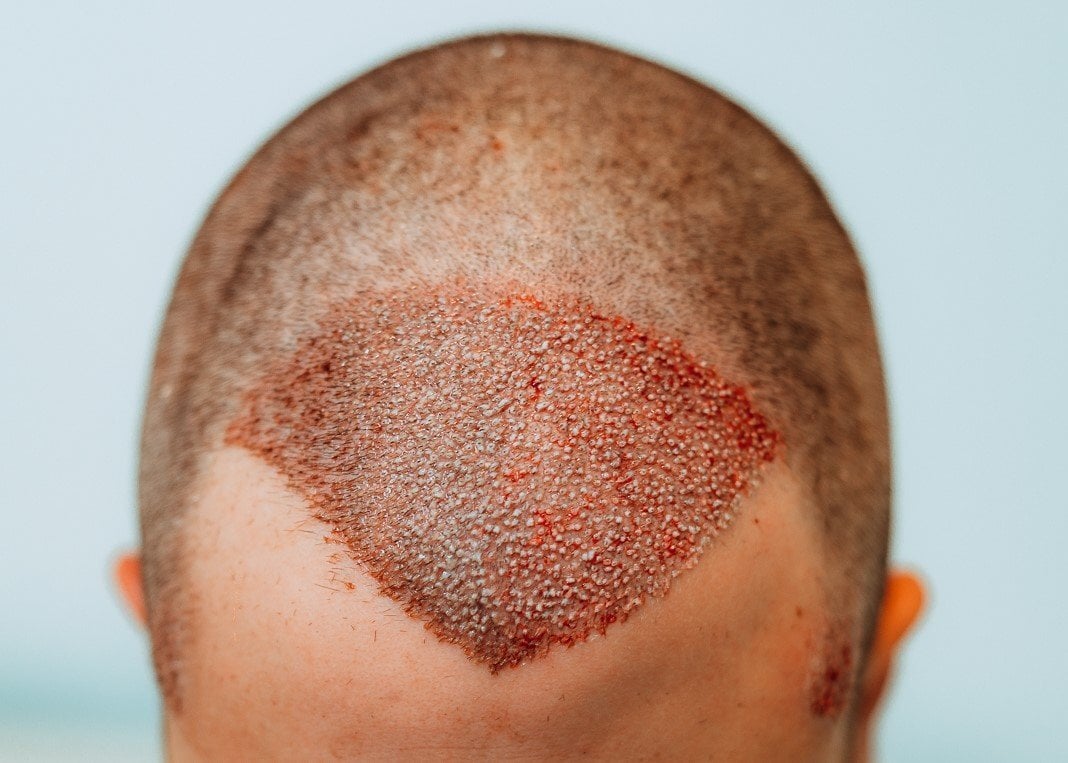 2,000 Grafts. Hairline, temples and center lock with Dr Micaela, Mica ...