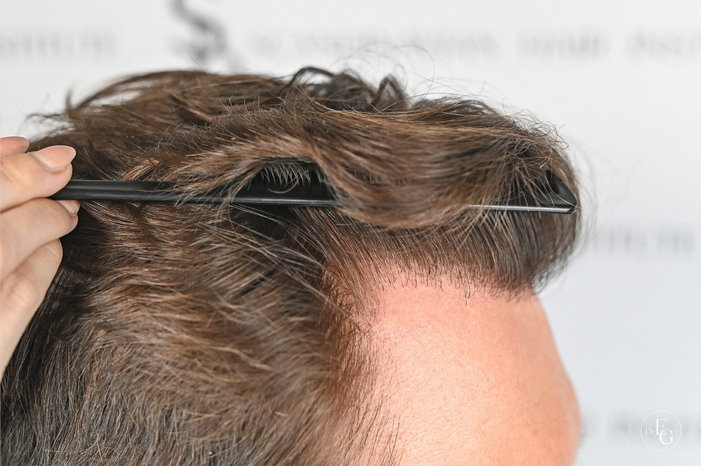 Dr Emil George, Oslo, Norway - 2500 grafts. Front and temporal peaks ...