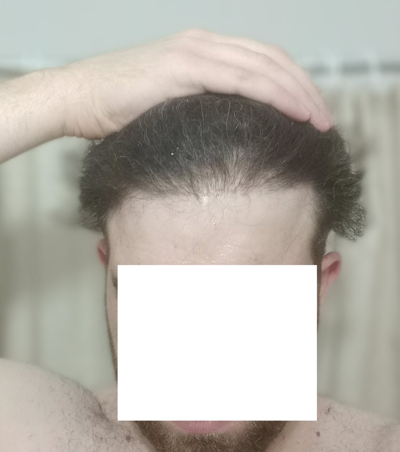 Looking for advice on choosing a surgeon for second hair transplant ...
